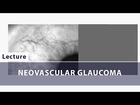 When Should You Refer For Prp Neovascular Glaucoma