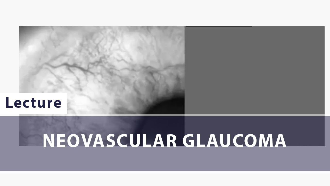 NEOVASCULAR GLAUCOMA - YouTube