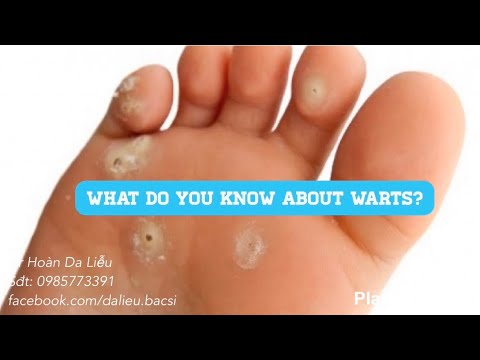 Dermatologist treating Human Papillomavirus, common warts, verruca ...