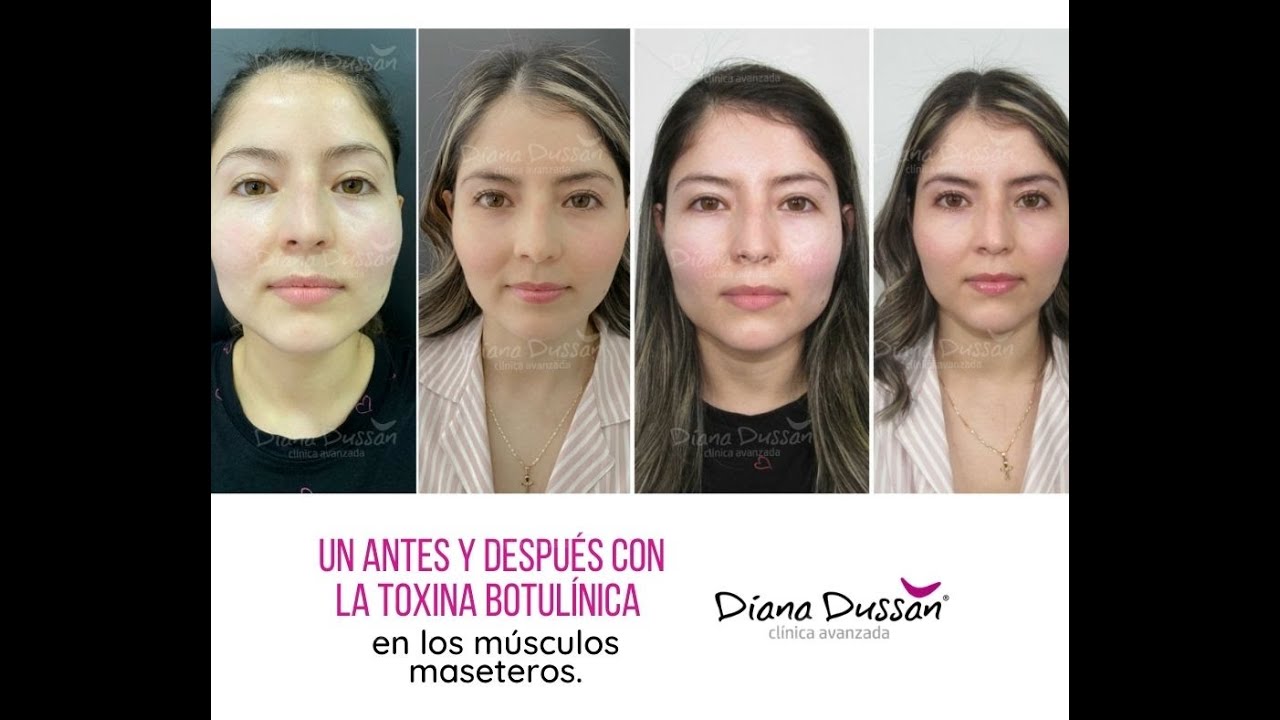 📍💉 Un antes y después con la Toxina Botulínica en los músculos ...