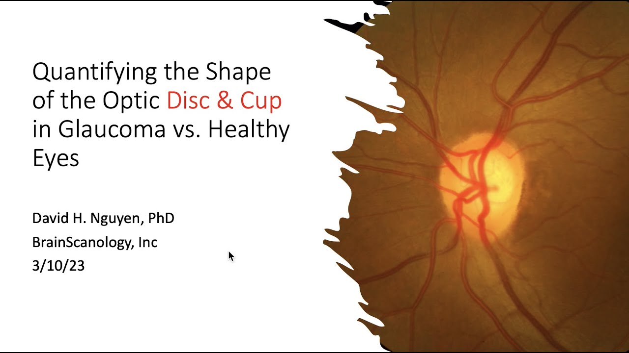 Shape Genie Quantifies Optic Cup & Disc Shape Simultaneously for ...