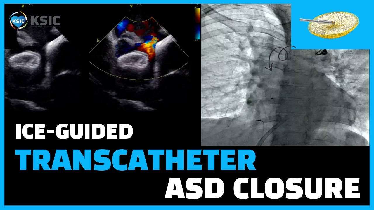 [SUB]Transcatheter ASD closure (ICE-guided) - YouTube