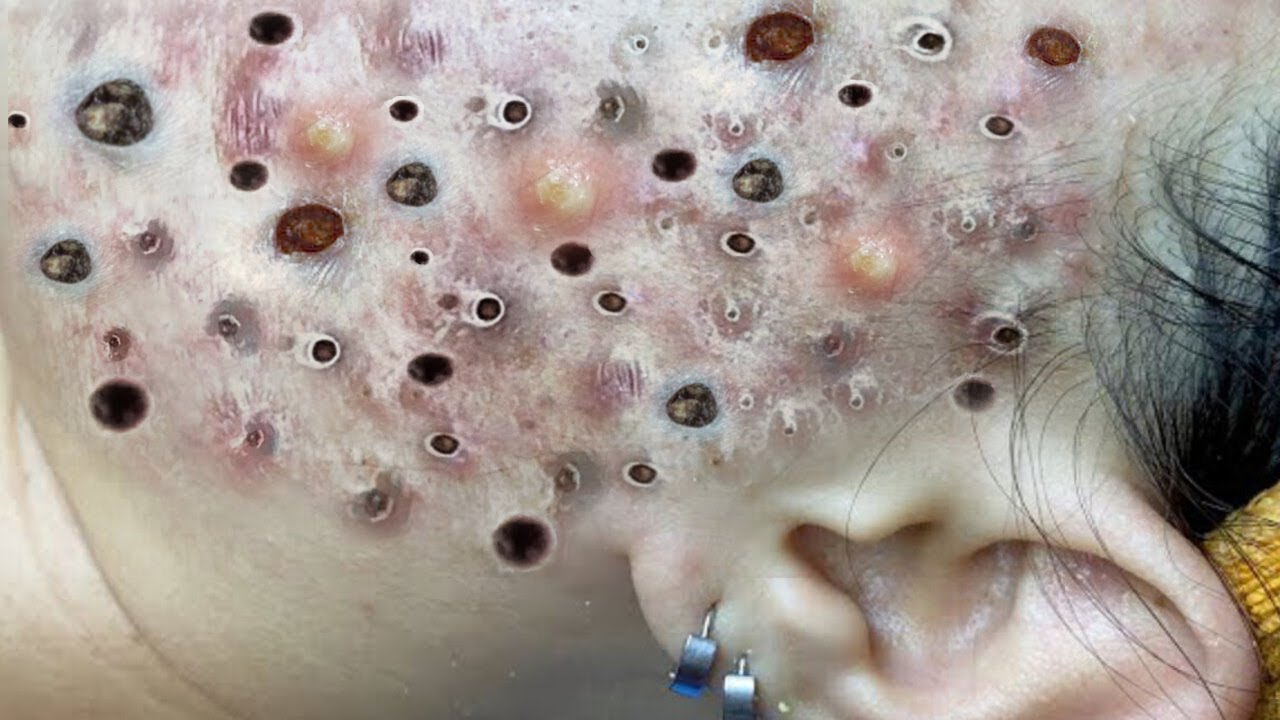 Blackhead Removal With Sac Dep Spa @100074845 - YouTube