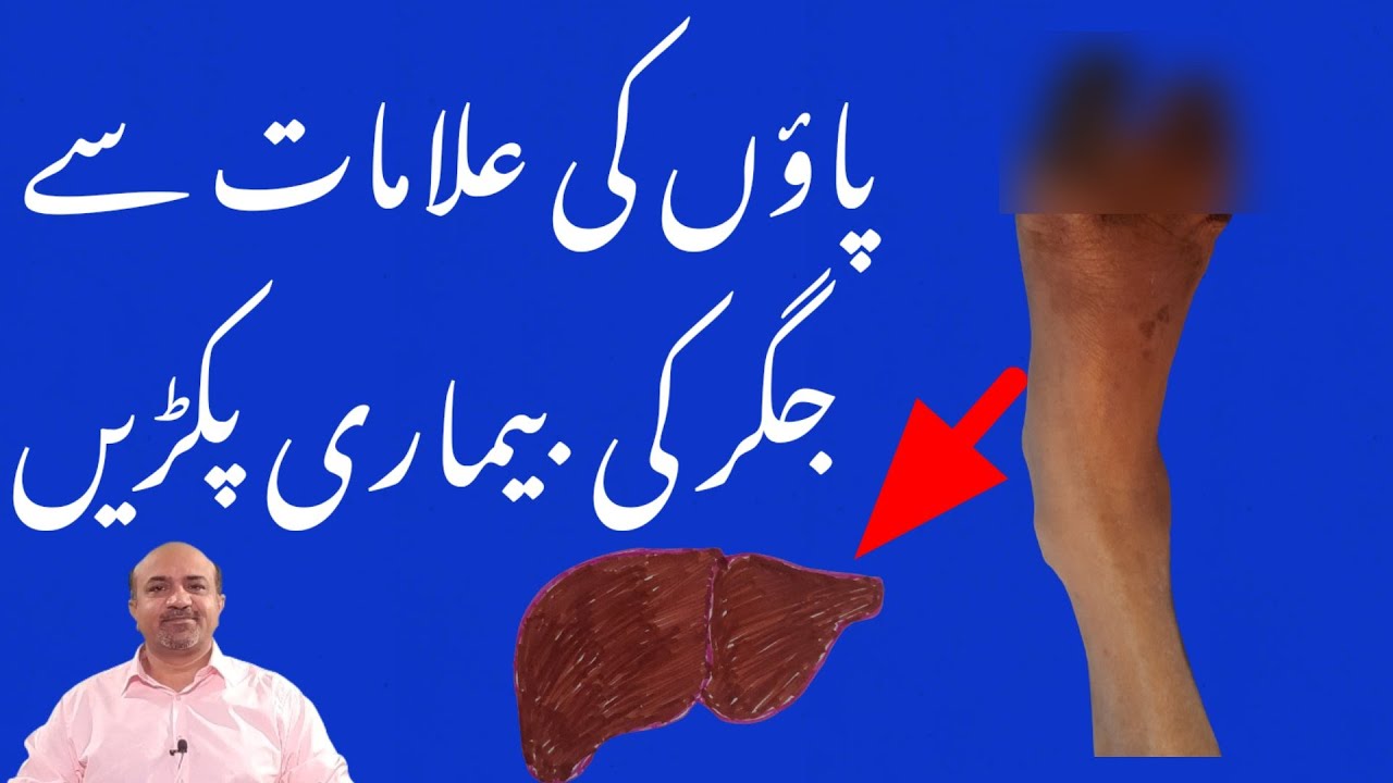 Important Signs Of Liver Disease In Feet & Lower Leg | جگر کی بیماری ...