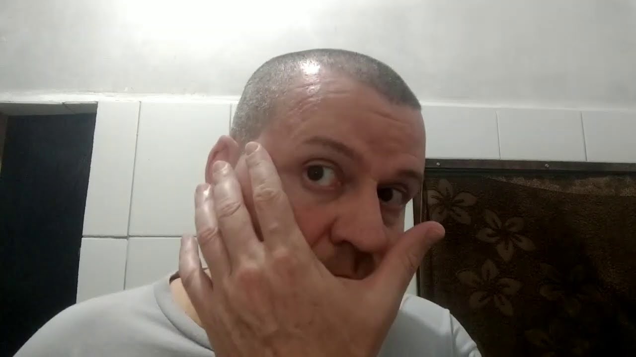 Tratamento pré câncer de pele com Efurix parte III - YouTube