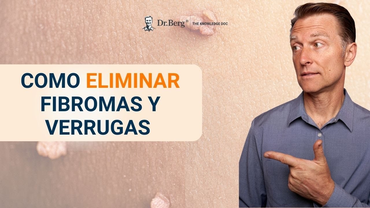 Como eliminar fibromas blandos de piel y verrugas - YouTube