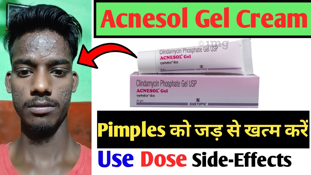Acnesol Gel Cream Use Dose Side-Effects Precautions And Review - YouTube