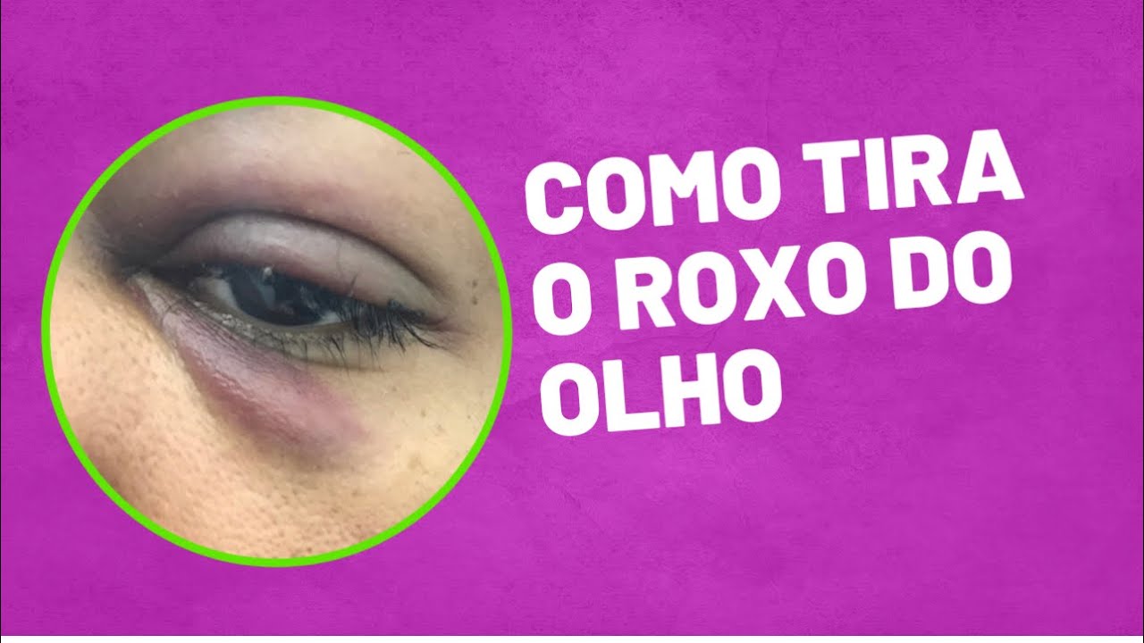 Como Tirar Roxo do olho , Hematomas no corpo e Chupão no pescoço - YouTube