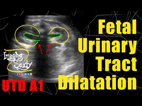 Fetal Urinary Tract Dilatation (UTD) || Ultrasound || Anomaly || Case ...