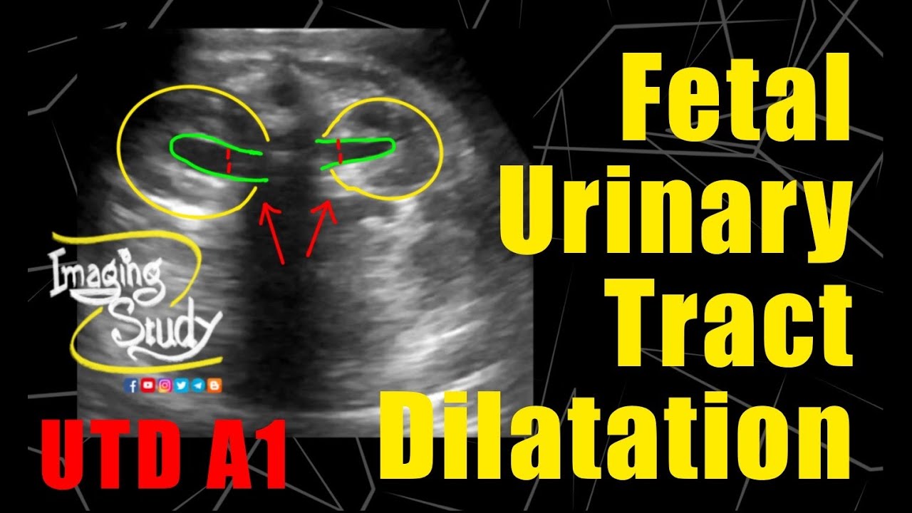 Fetal Urinary Tract Dilatation (UTD) || Ultrasound || Anomaly || Case ...