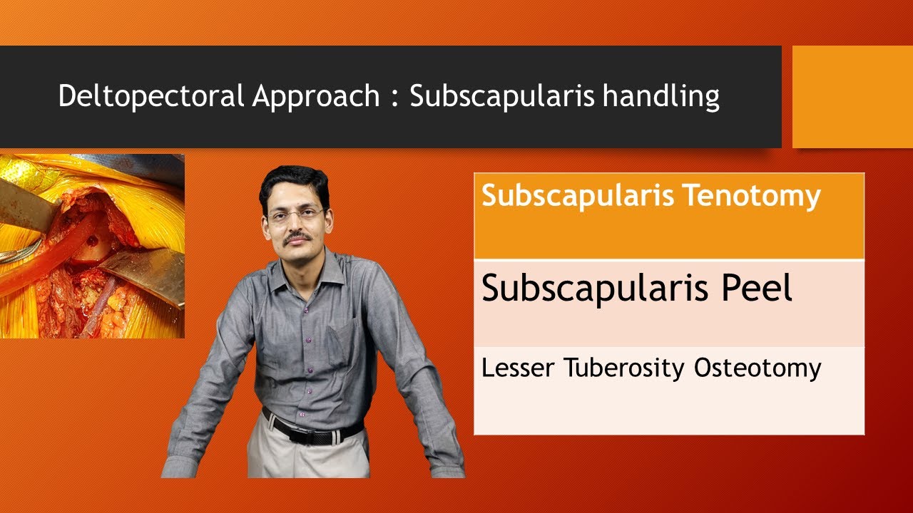 Deltopectoral approach : Subsacpularis Handling. - YouTube
