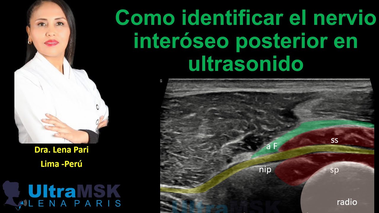 Como identificar el nervio interóseo posterior en ultrasonido o ...