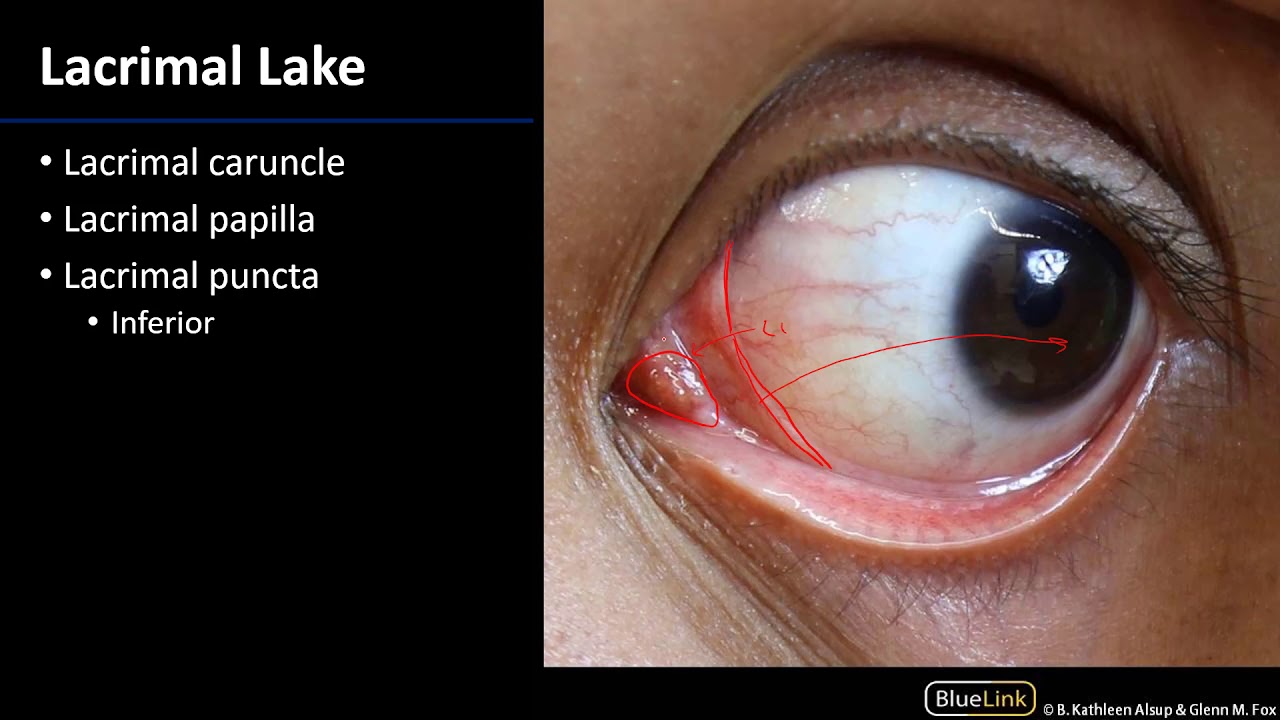 Caruncula Lacrimal Inchada Recurrent Lacrimal Gland Adenoid Cystic