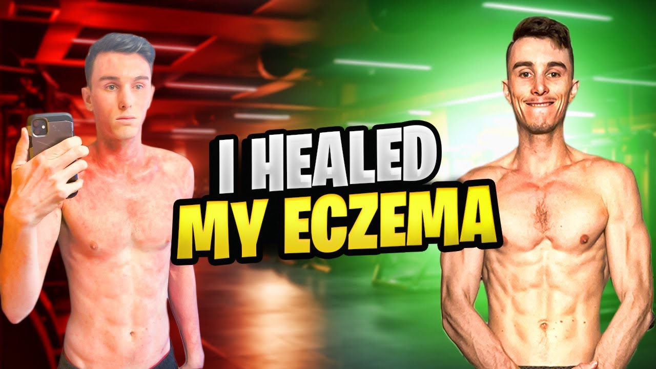 Healing Eczema Naturally and Permanently - YouTube