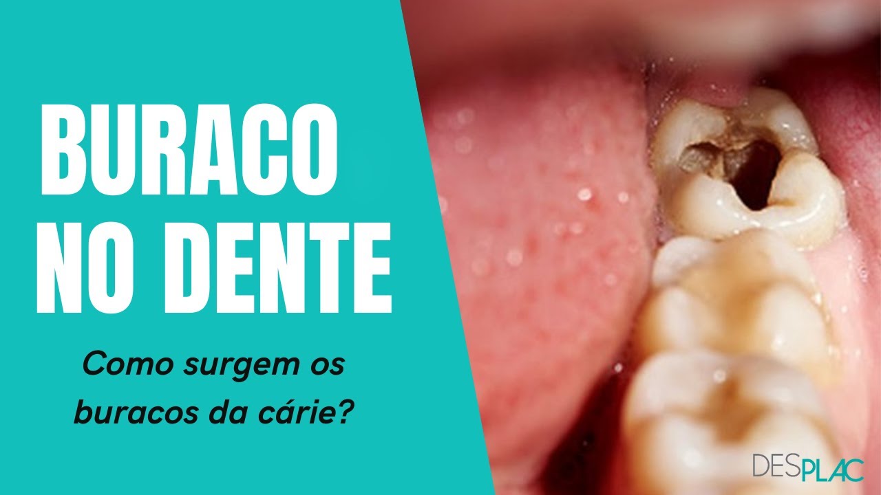 BURACOS NOS DENTES - COMO SURGEM? - YouTube