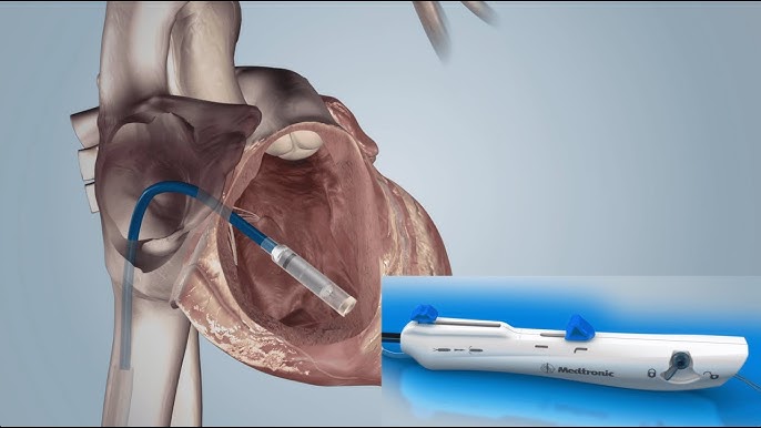 Pacemaker Implantation Youtube
