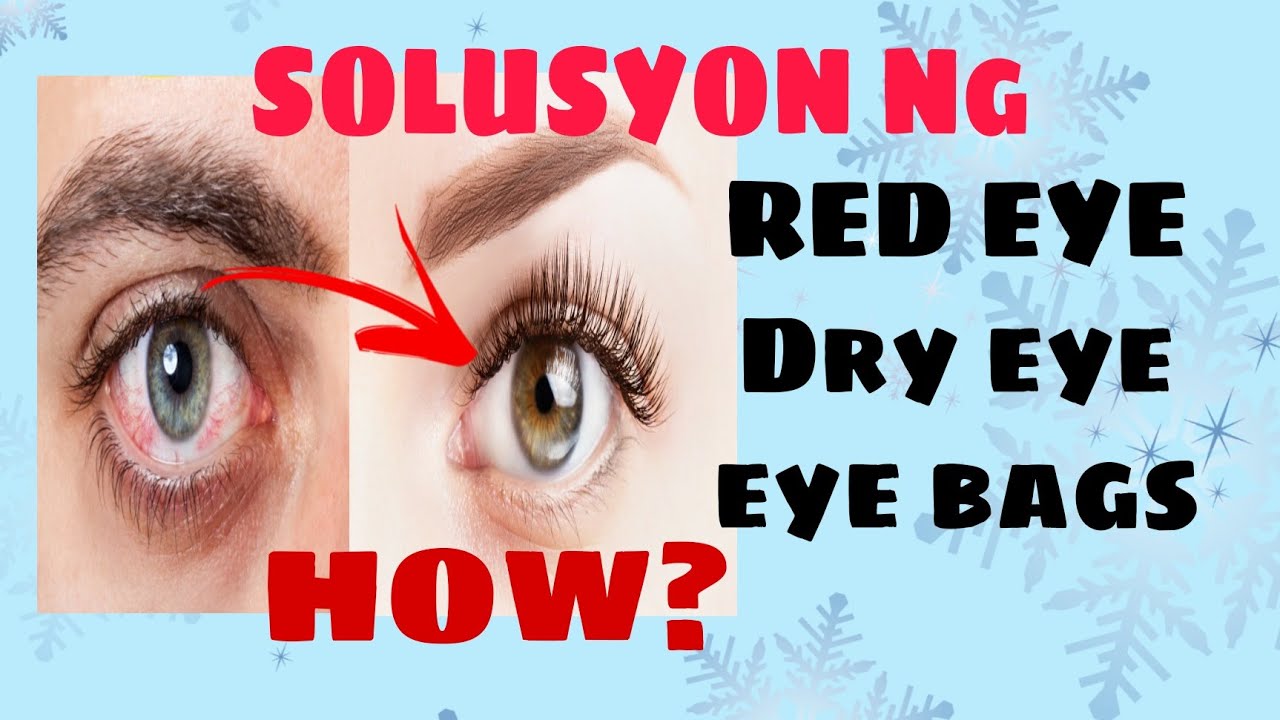 Solusyon sa eyebags and DRY EYE panourin hanggang dulo kung PAANO - YouTube