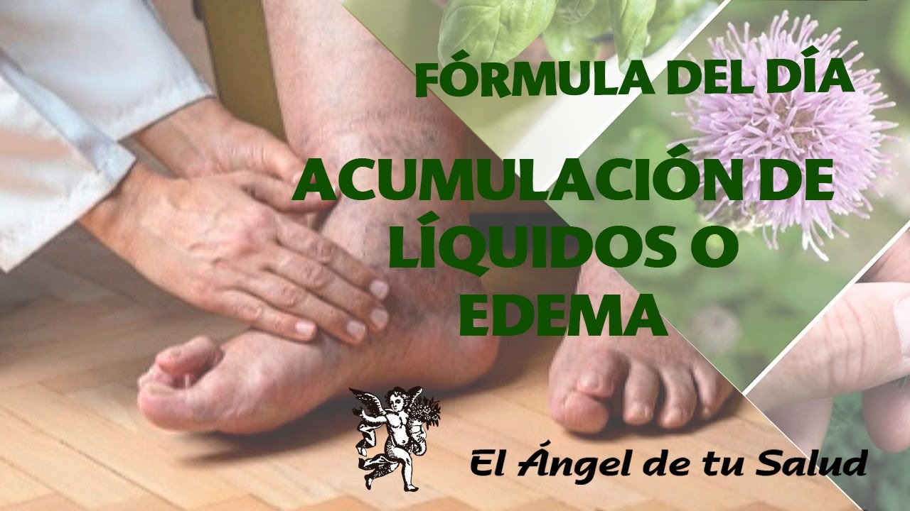 FÓRMULA HERBOLARIA PARA LA ACUMULACIÓN DE LÍQUIDOS O EDEMA - YouTube