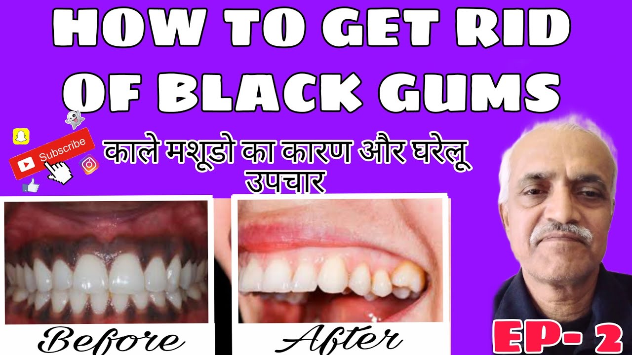 Black gums treatment/Black gums to pink/dark gums treatment/ #shorts ...