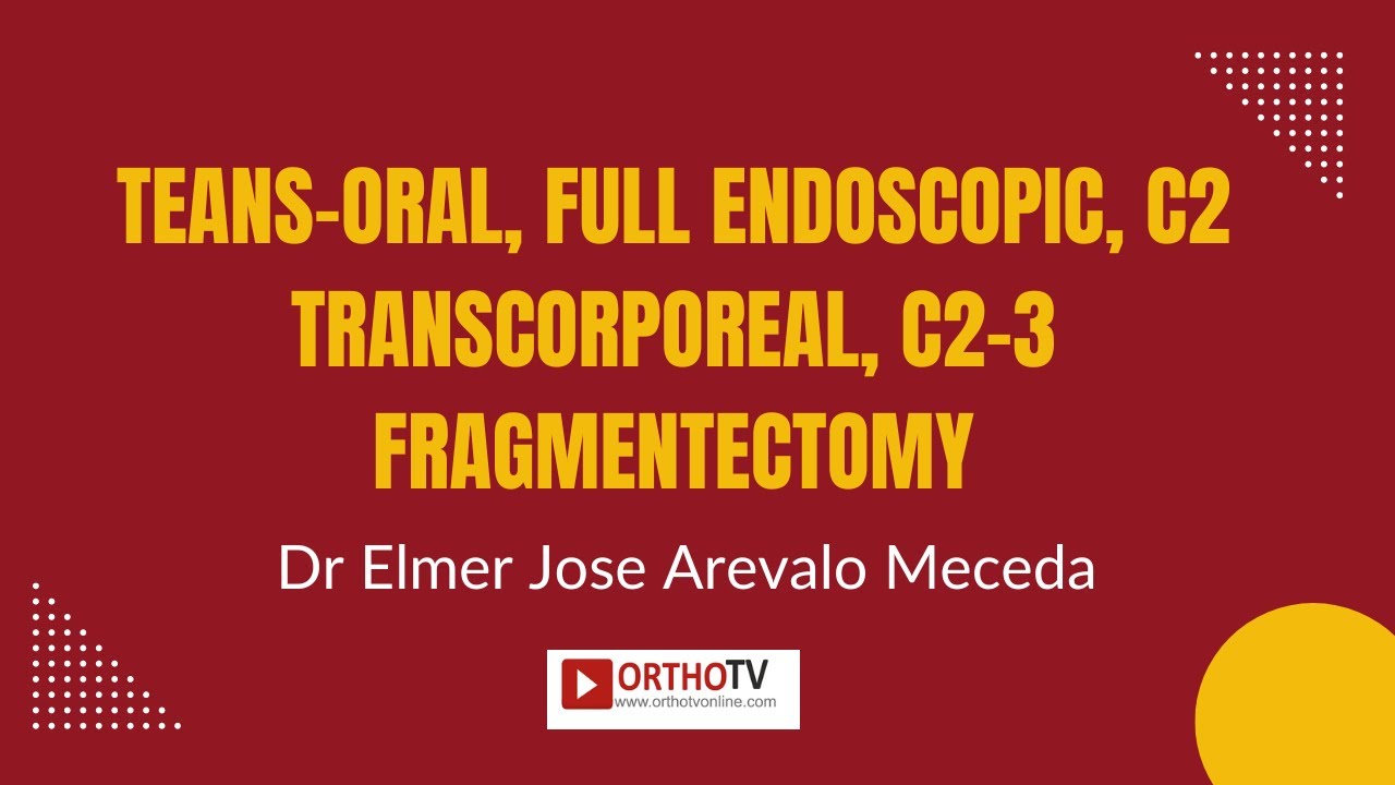 Teans-Oral, Full Endoscopic, C2 Transcorporeal, C2-3 Fragmentectomy ...