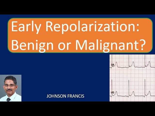 Benign Early Repolarization Dr. Smith's ECG Blog: Acute Anterior