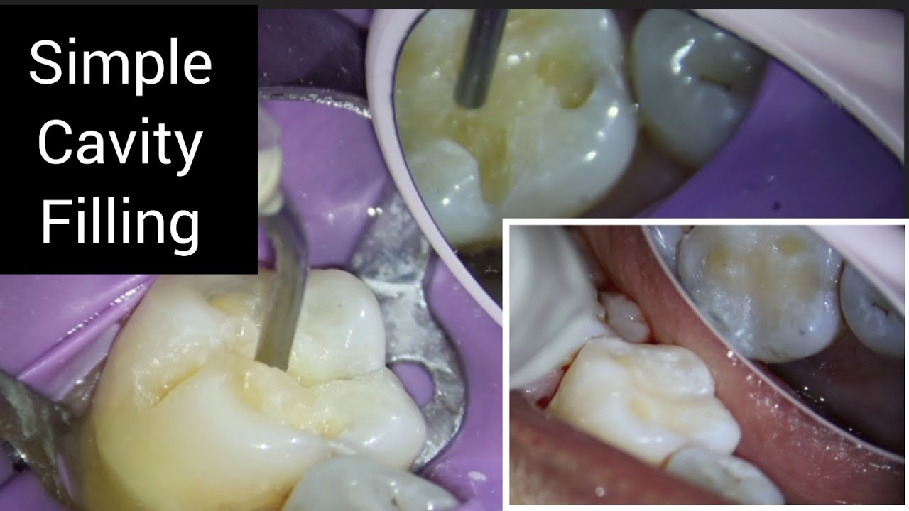 Small Cavity Composite Restoration under Dental Operating Microscope ...