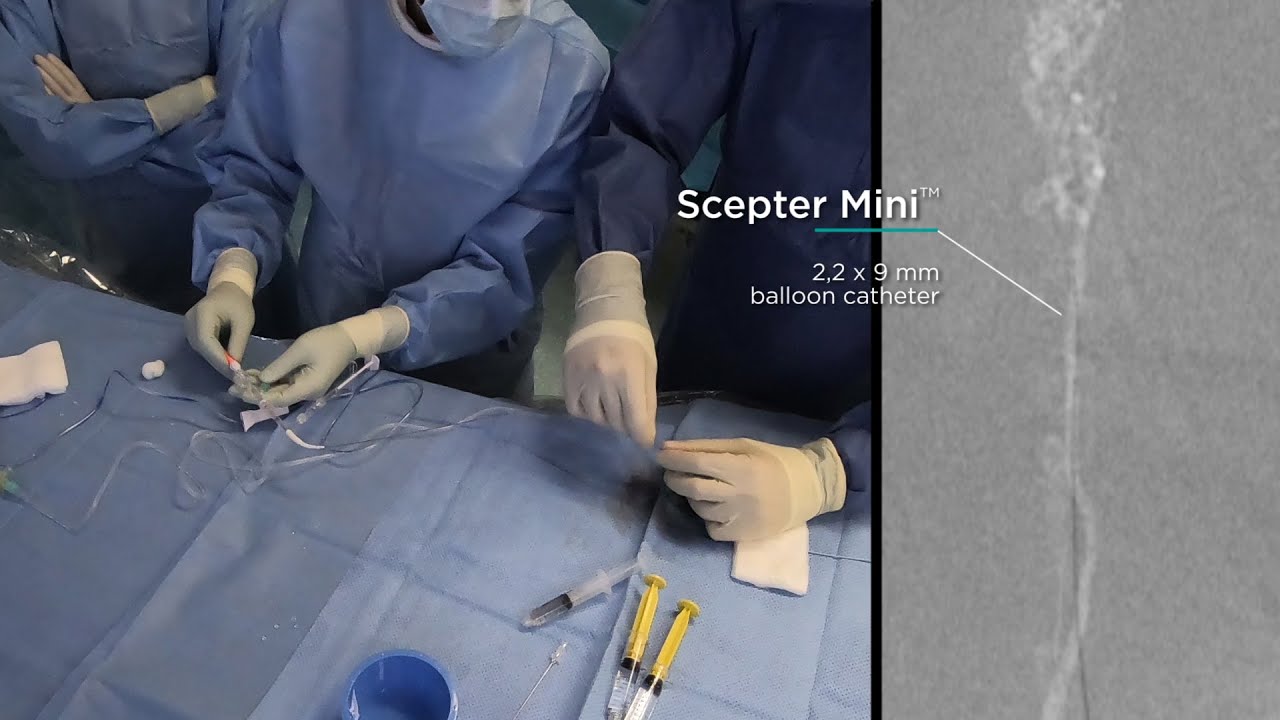 Embolisation of spinal AVM through Scepter Mini™ balloon catheter - YouTube