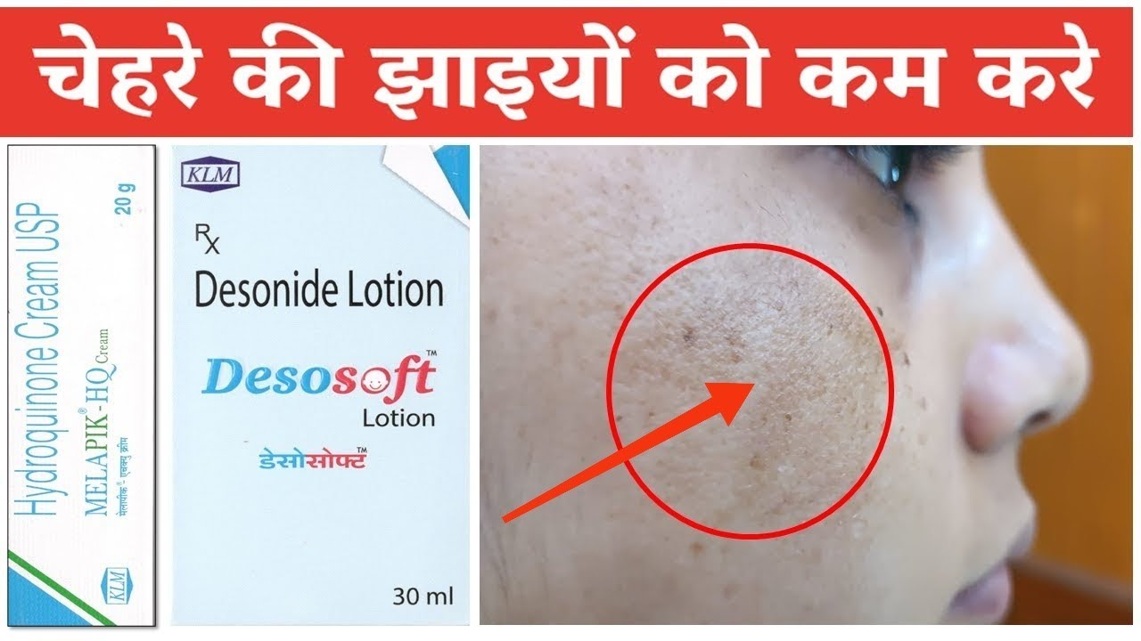 Melapik HQ + Desosoft Lotion | Treatment of Melasma | चेहरे की झाइयों ...