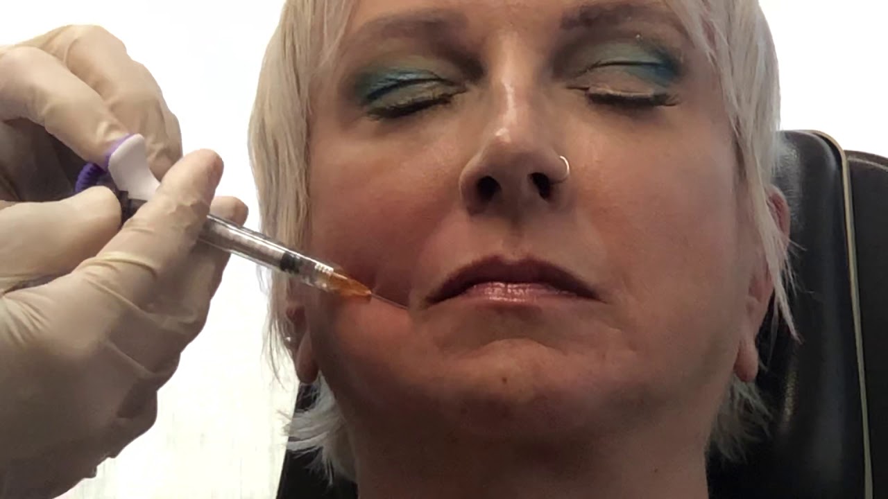 Continuation of Injectable filler treatment to pre-jowls & marionettes ...