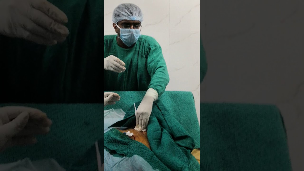 How To Insert Heamodialysis Catheter Permacath - YouTube