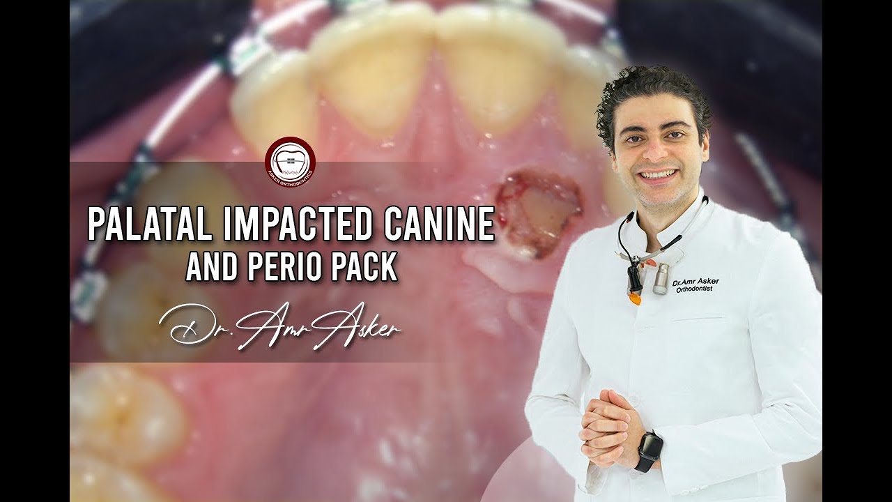 open eruption of palatal impacted canine and perio pack - YouTube