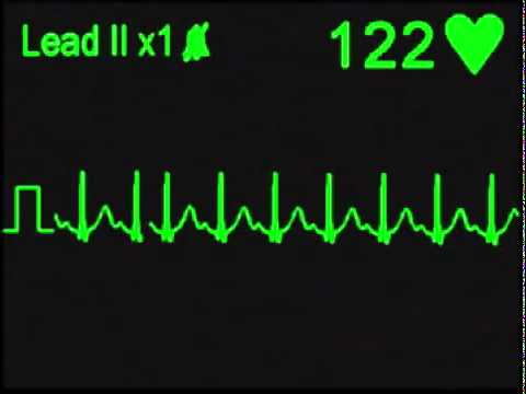 Taquicardia Sinusal / Sinus Tachycardia - YouTube