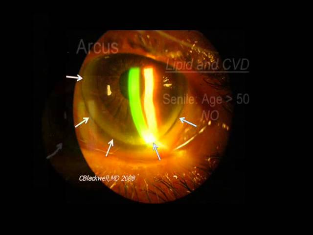 Limbus Sign And Arcus Senilis