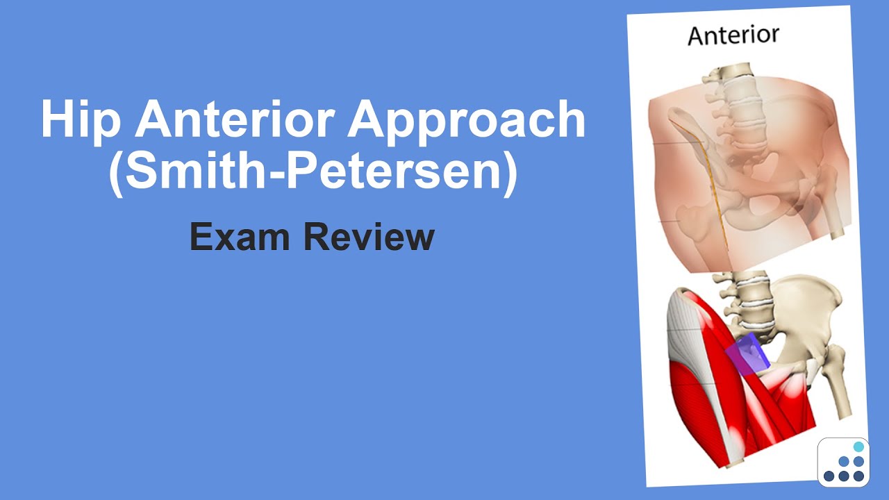 Hip Anterior Approach (Smith-Petersen) Exam Review - Doug Padgett, MD ...