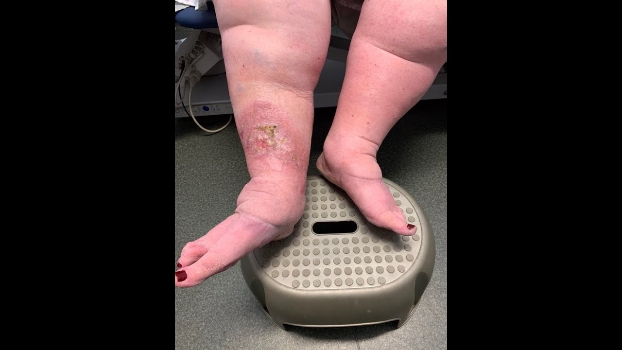 Clinical Tip 3 - A simple overview to managing lower leg swelling - YouTube