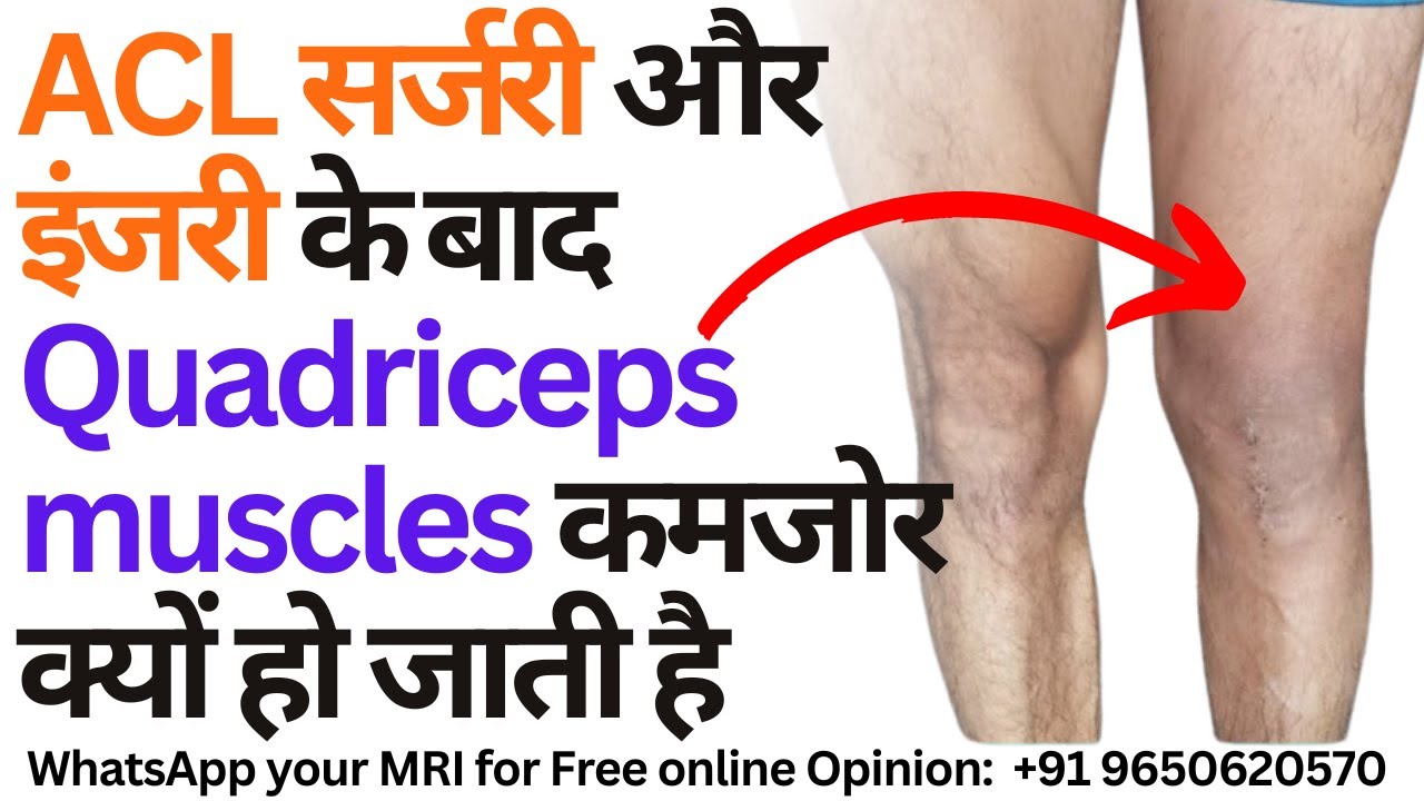 ACL सर्जरी और इंजरी के बाद Quadriceps muscles कमजोर क्यों हो जाती है ...