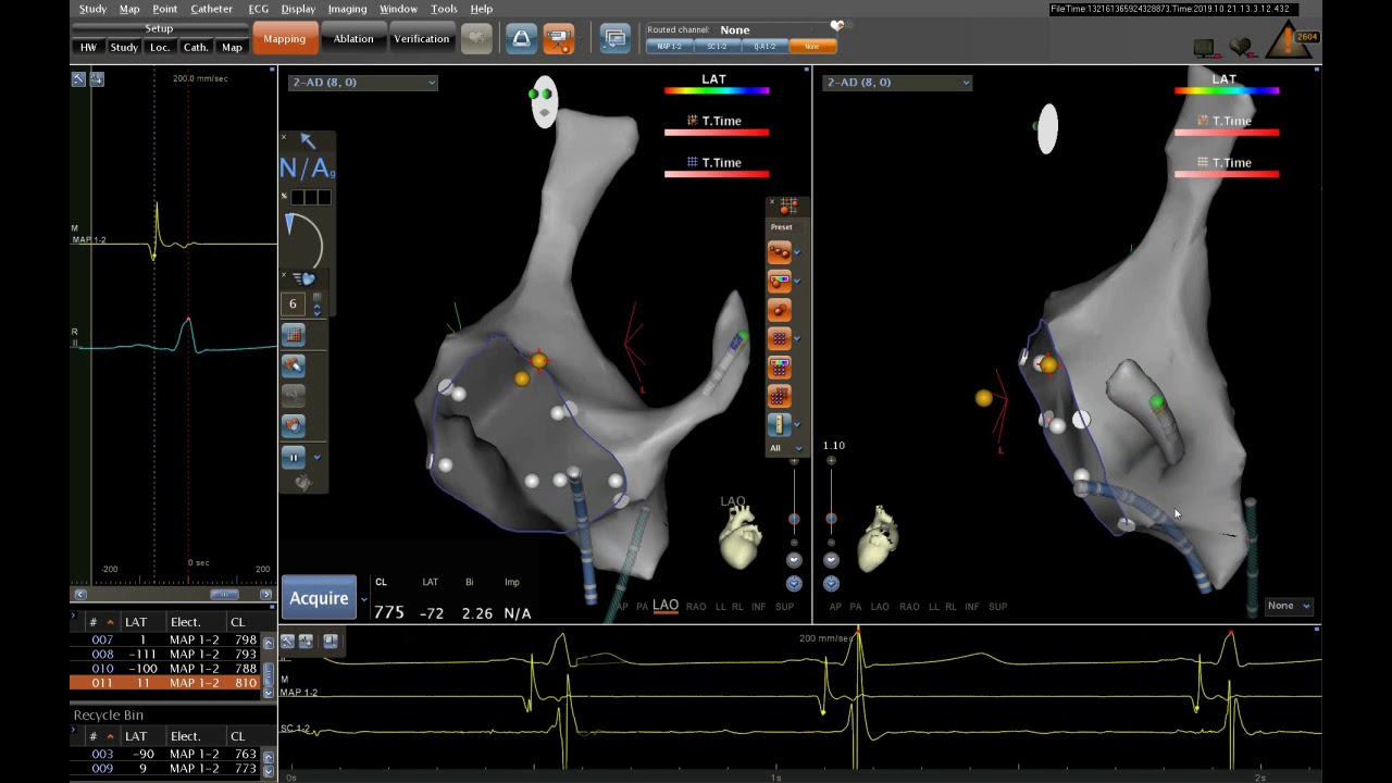 Non-fluoroscopic catheter positioning for SVT ablation - YouTube