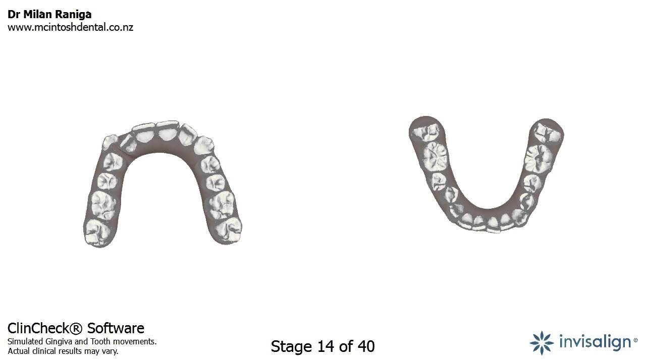 Invisalign animation showing tooth movement - YouTube