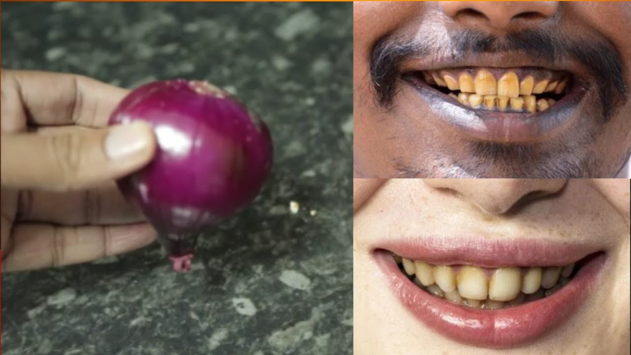 Magic Onion | Teeth Whitening | Natural Home Remedy | Moon Maker ...