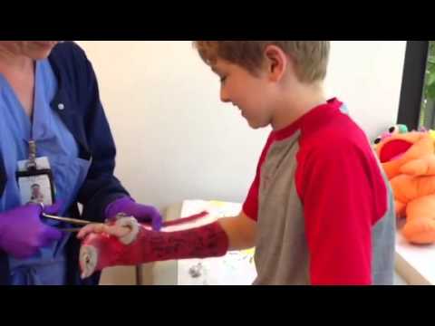 Removing a Cast - YouTube