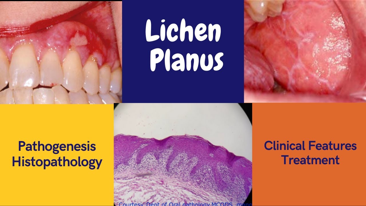 Lichen planus - YouTube