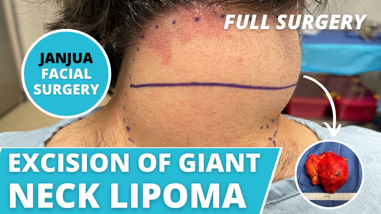 EXCISION OF HUGE 10-YEAR-OLD NECK LIPOMA - DR. TANVEER JANJUA - NEW ...