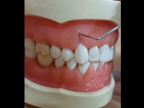 Stillman's cleft - YouTube
