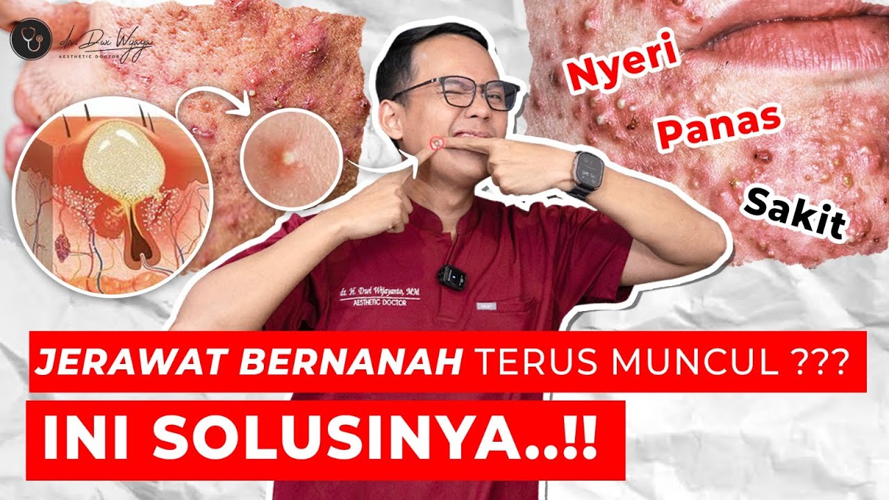 PENYEBAB DAN CARA ATASI JERAWAT BERNANAH - MUDAH BANGETT!! | dr. DWI ...