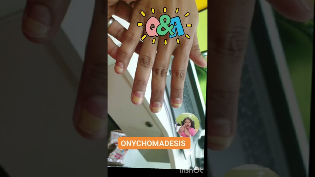 Nail shedding ( ONYCHOMEDESIS) - YouTube