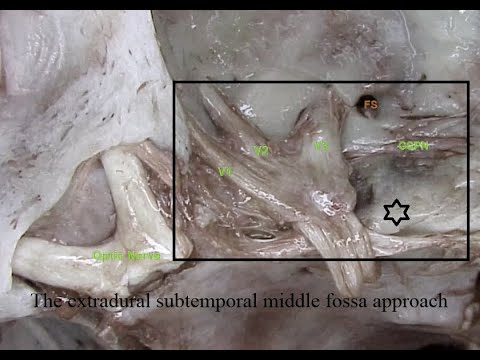 Extradural Subtemporal Approach to the Middle Fossa How I Perform Prof ...