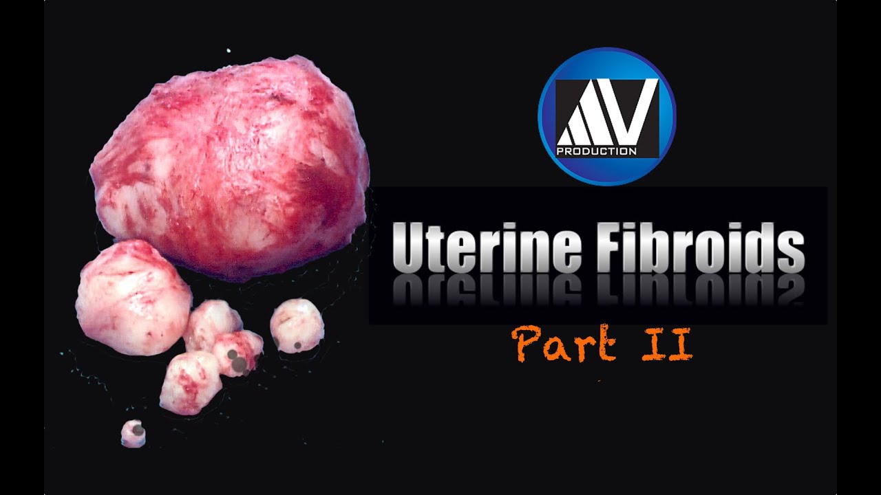 Fibroids Part II - YouTube