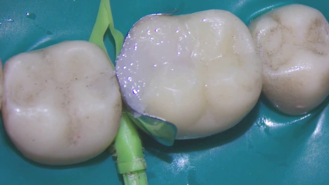 Etching ,Bonding steps ,Composite build up and Finishing protocol - YouTube