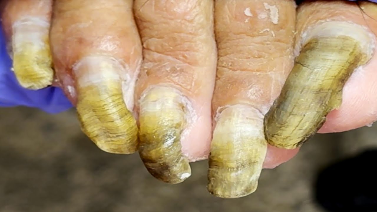 Extremely Long Toenails, Easily Trimmed One By One【Podiatry Clinic ...