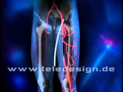 HGL 035 Bypass Bein - SD PAL / HGL 035 leg bypass - SD PAL - YouTube